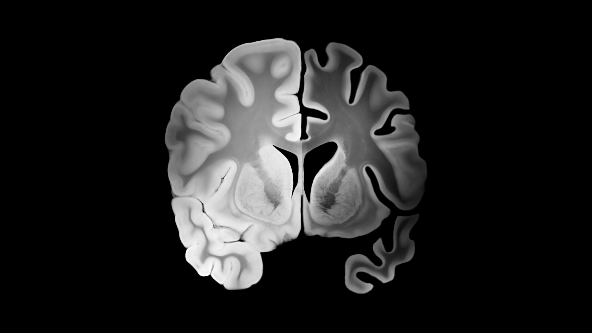 University of Toronto researchers identify potential biomarker linked ...
